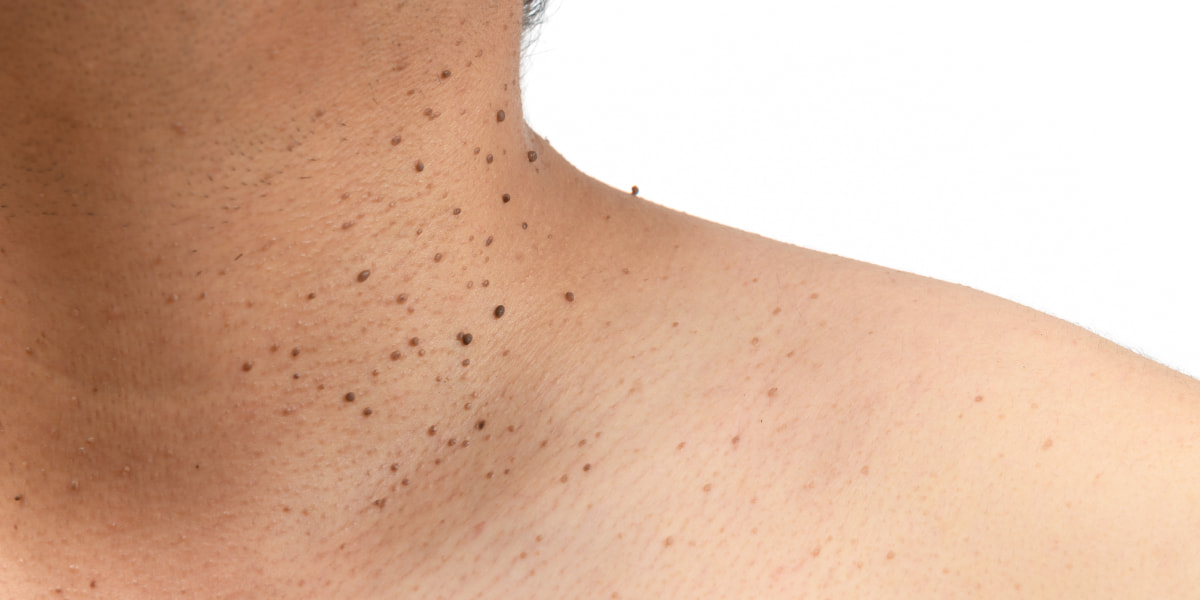 Skin Nodule Treatment Skin Nodule Treatment